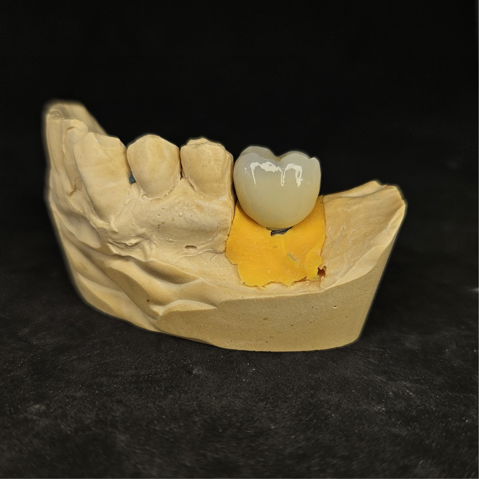 Prótese Dentária - Consultório Dr. Vinícius Meyer Manicardi
